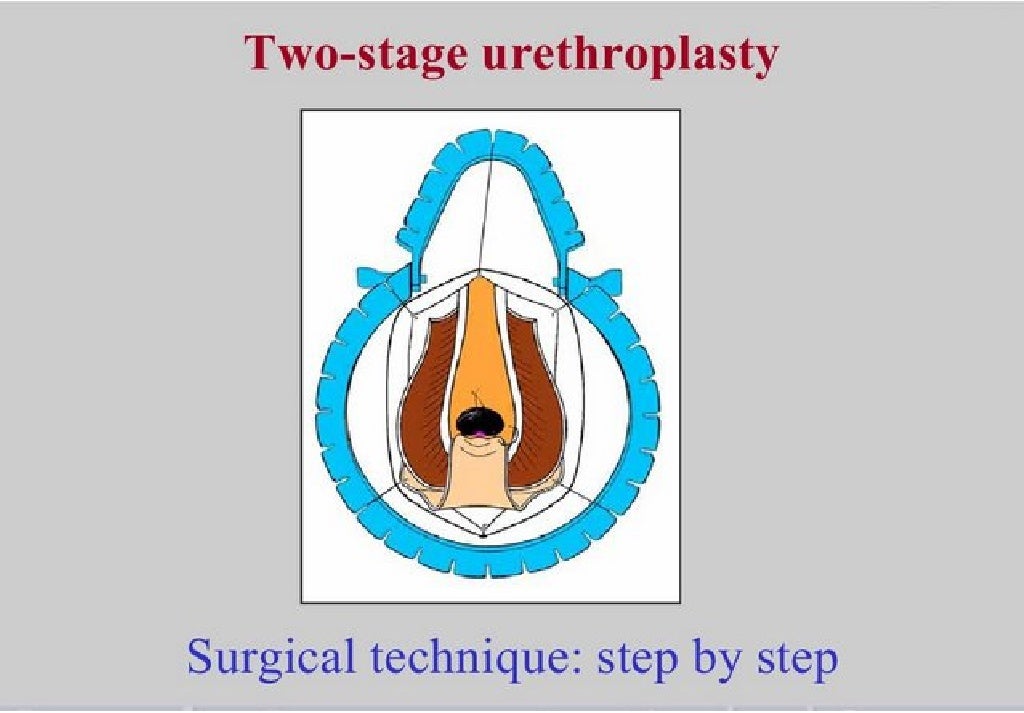 Two stage urethroplasty of bulbar urethra