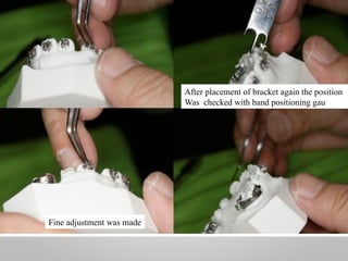 Two By Four Appliance in Pediatric Dentistry | PPTX