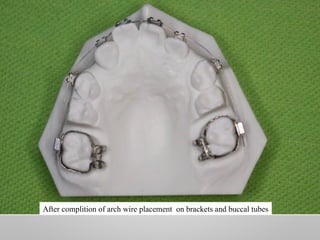 Two By Four Appliance in Pediatric Dentistry | PPTX