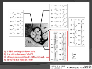 Case report_two cases of ventricular tachycardia | PDF