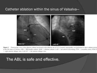 Case report_two cases of ventricular tachycardia | PDF