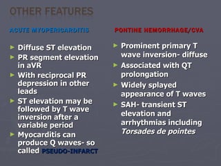 Two Interesting ECGs | PPT