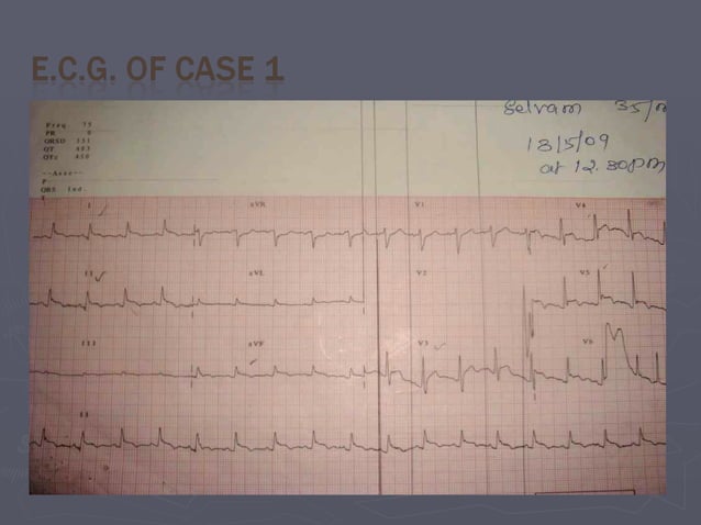 Two Interesting ECGs | PPT