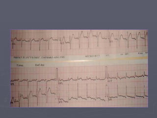 Two Interesting ECGs | PPT