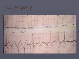 Two Interesting ECGs | PPT
