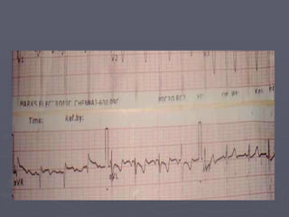 Two Interesting ECGs | PPT