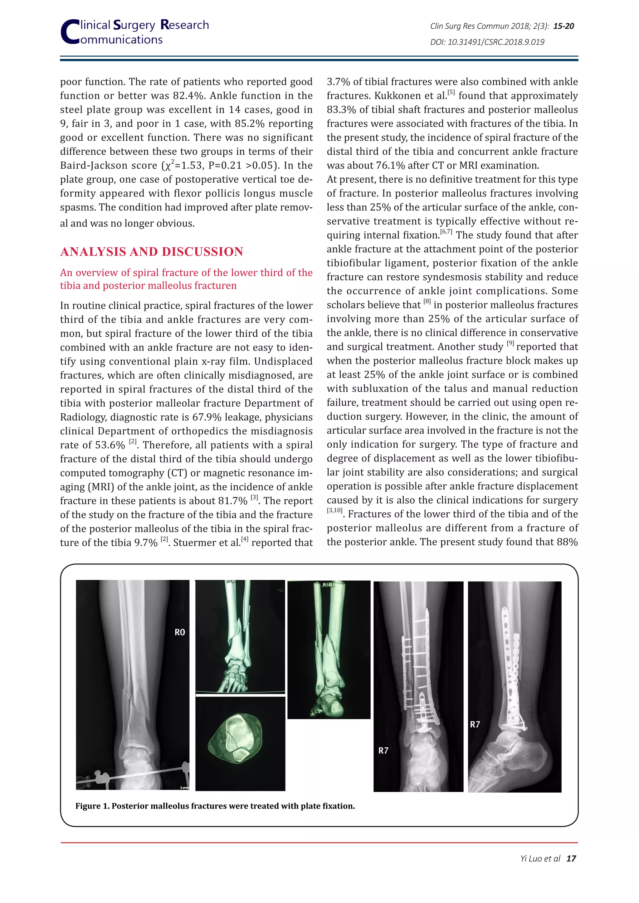 Two treatment methods for spiral fracture of the lower third of the ...