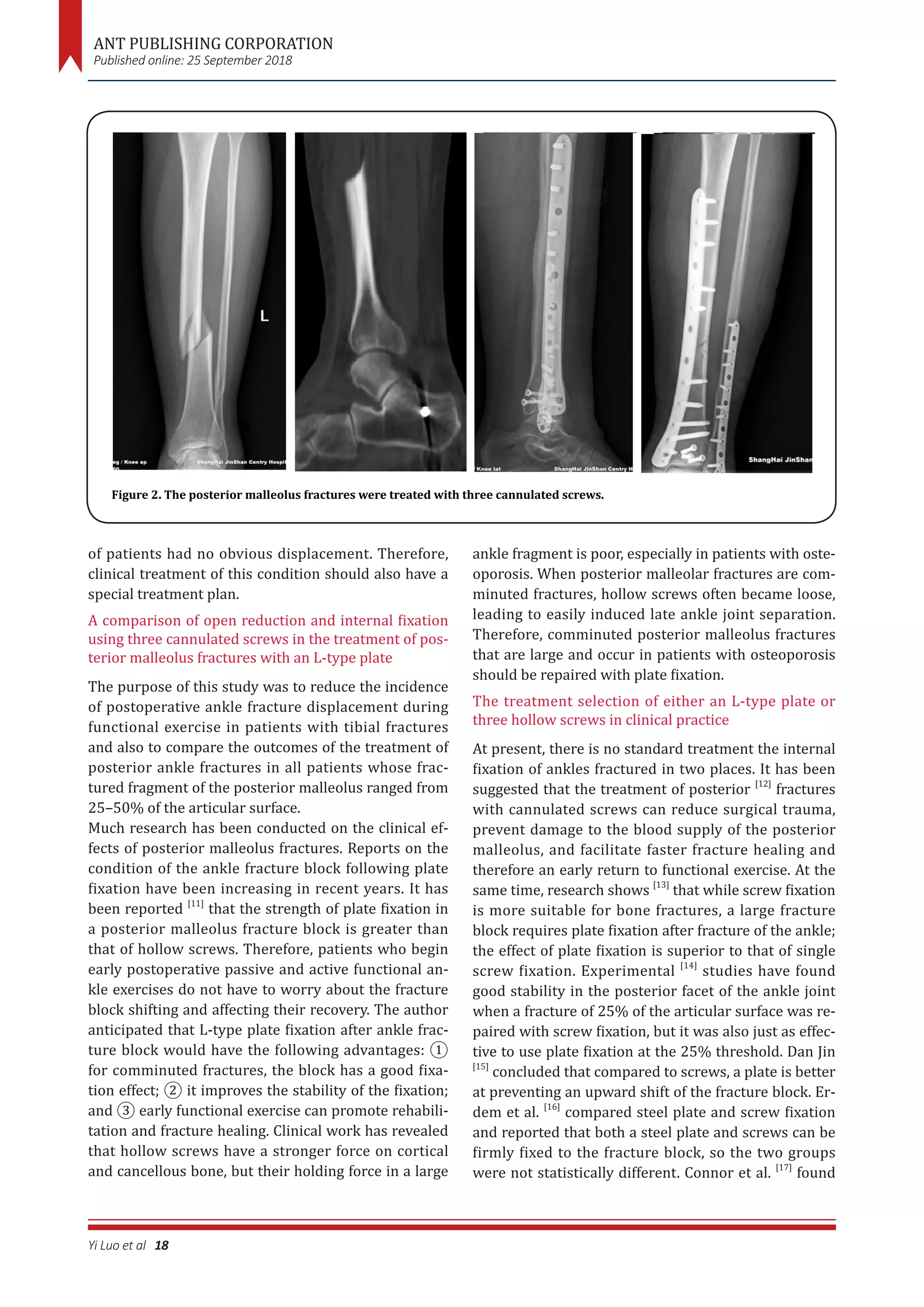 Two treatment methods for spiral fracture of the lower third of the ...