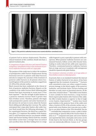 Two treatment methods for spiral fracture of the lower third of the ...