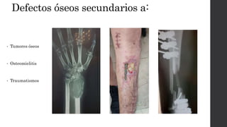 TX DEFECTOS ÓSEOS SEGMENTARIOS.pptx