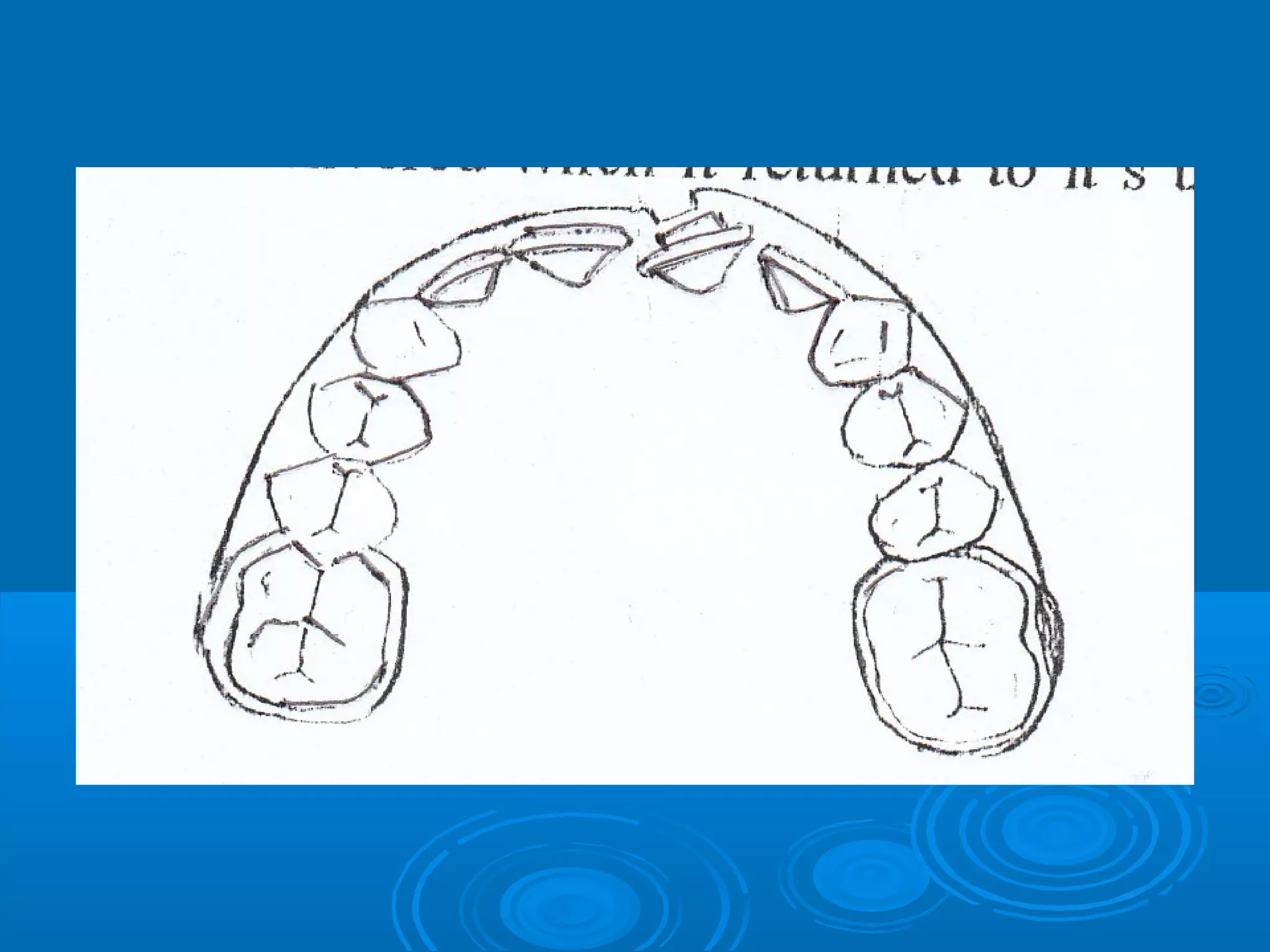 Treatment of crowding in permanent dentition | PPT