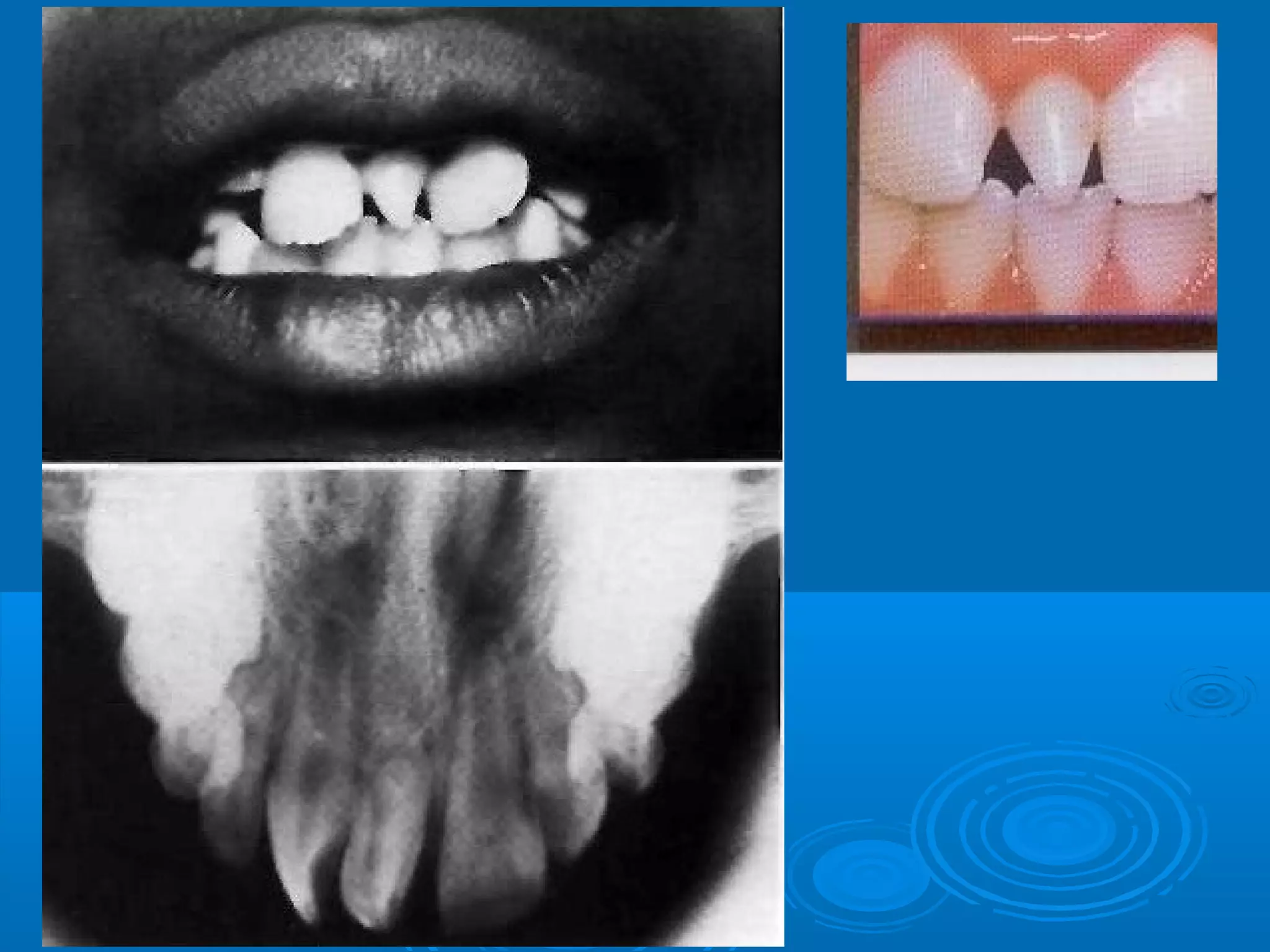 Treatment of crowding in permanent dentition | PPT