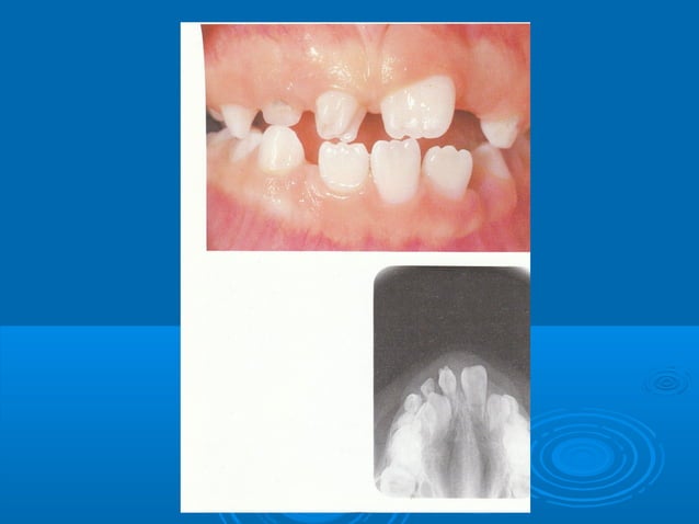 Treatment of crowding in permanent dentition | PPT