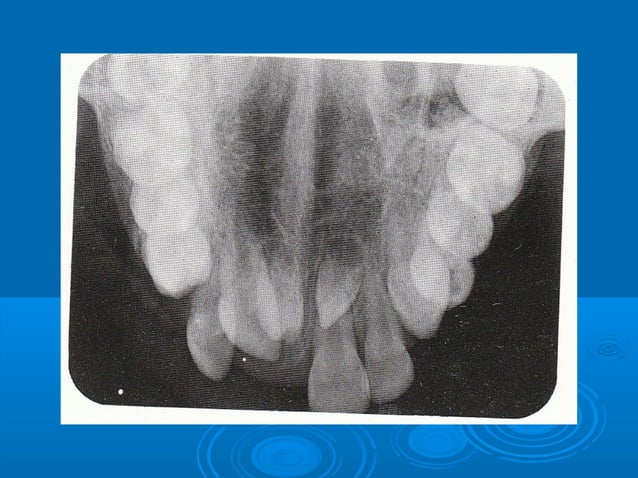 Treatment of crowding in permanent dentition | PPT