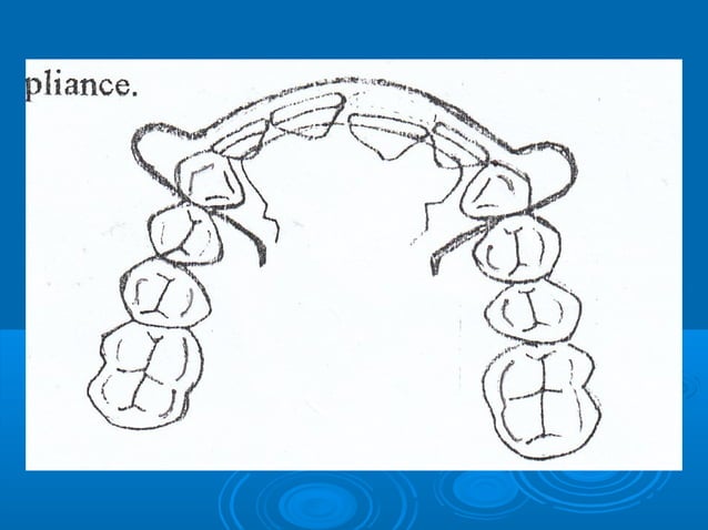 Treatment of crowding in permanent dentition | PPT
