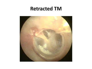 Tympanic membrane | PPTX