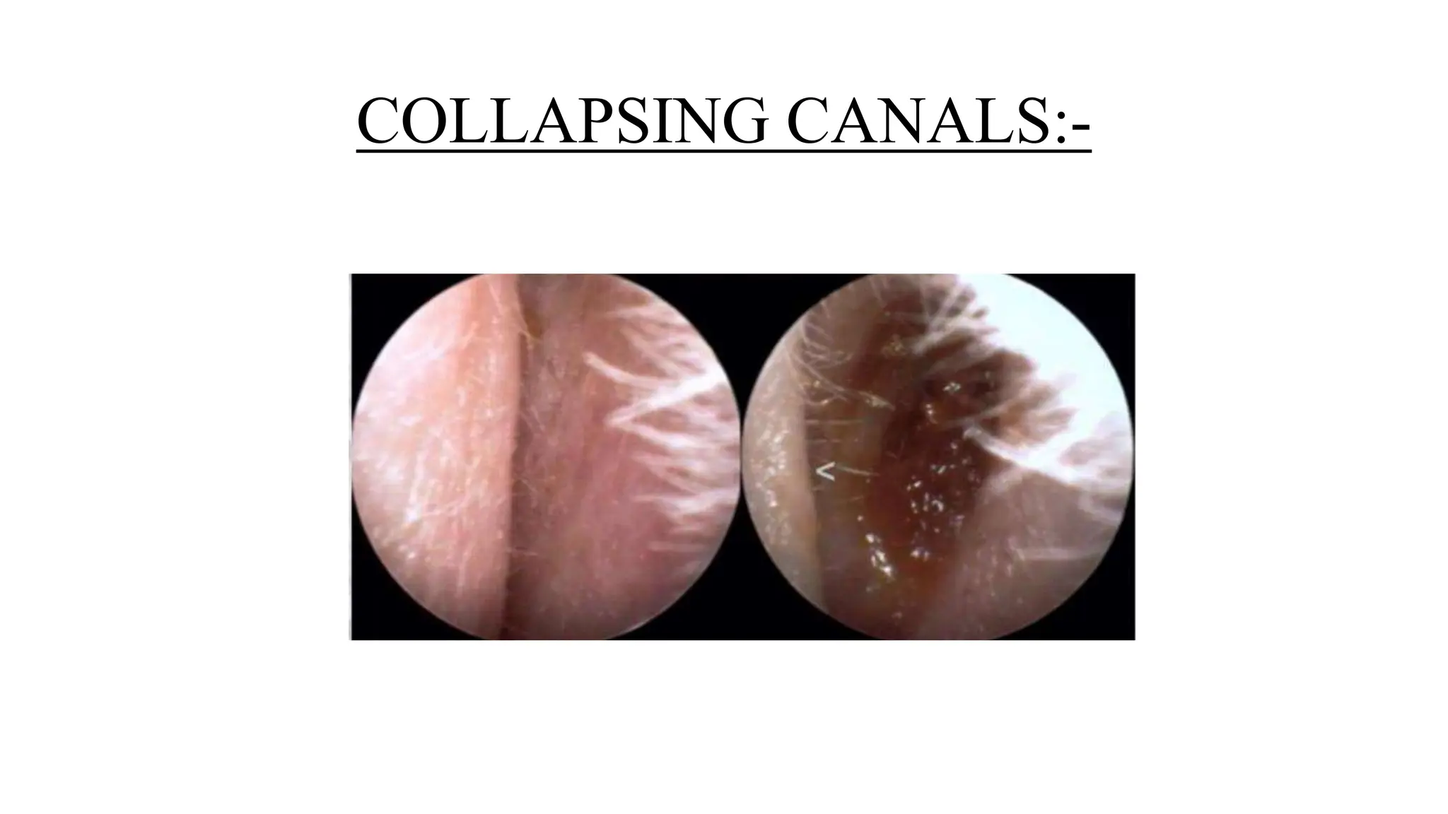 tympanic membrane.pptx