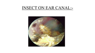 tympanic membrane.pptx