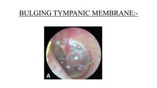 tympanic membrane.pptx