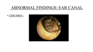 tympanic membrane.pptx