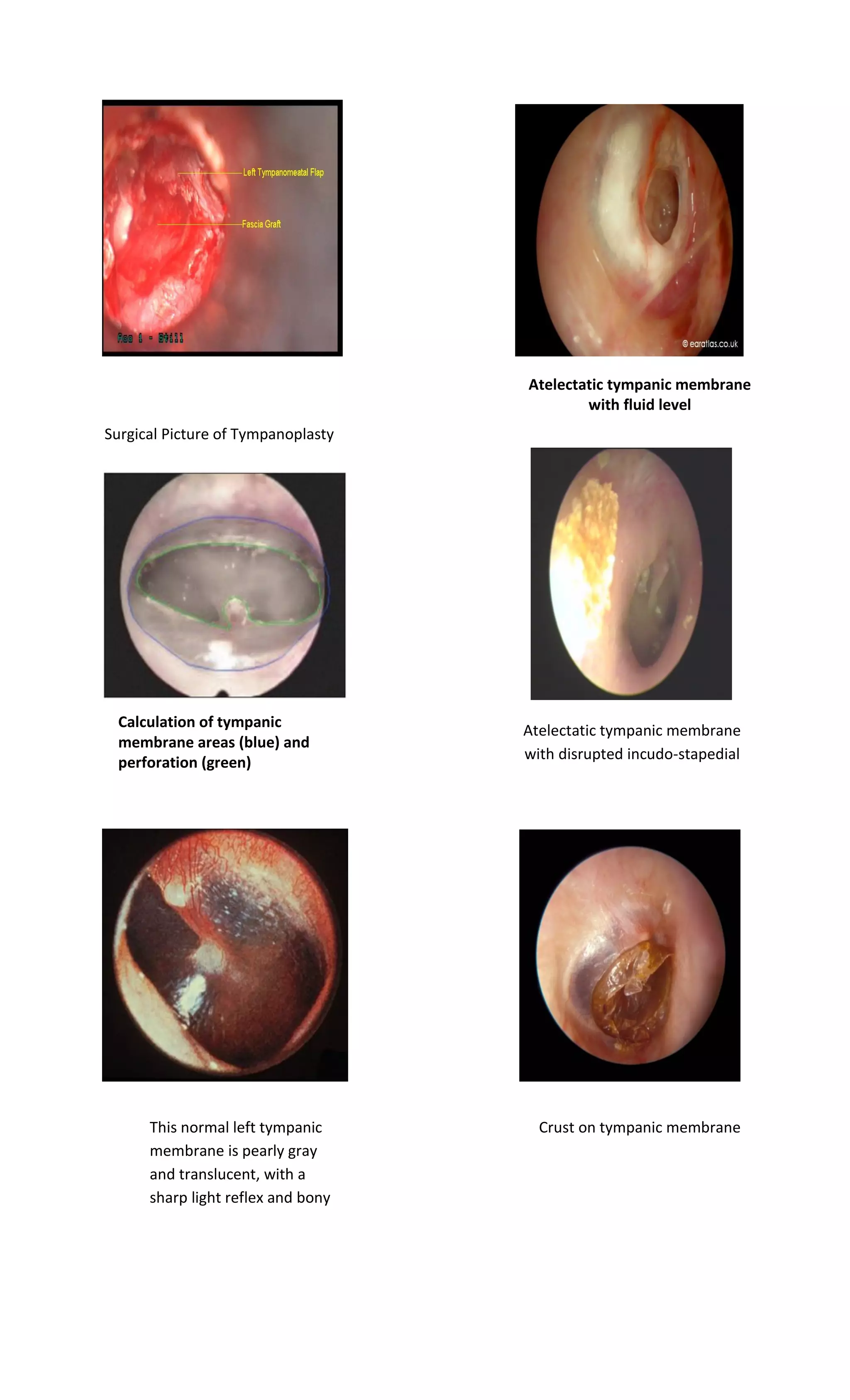 Tympanic membrane dr. fadil | PDF