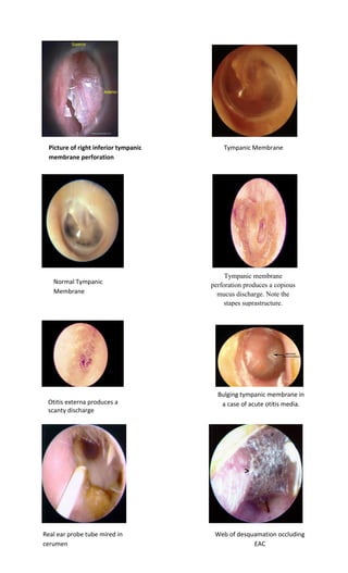 Tympanic membrane dr. fadil | PDF