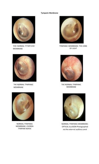 Tympanic Membrane With Effusion