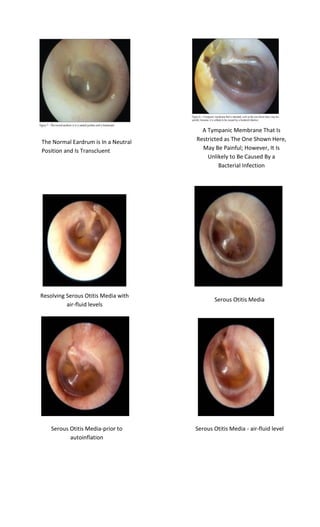 Abnormal Tympanic Membrane