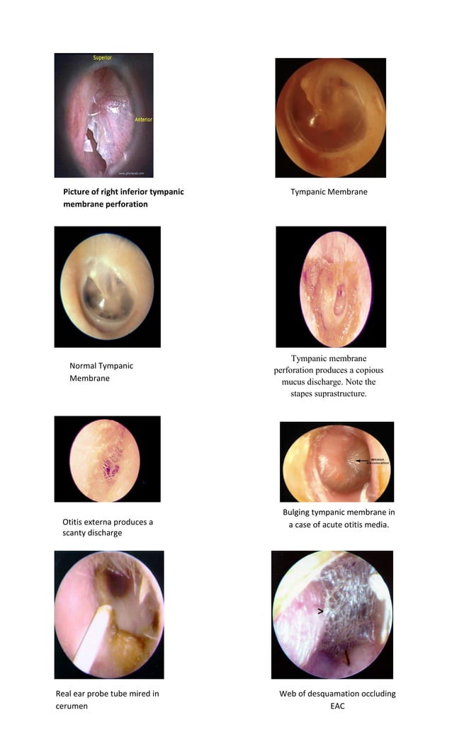 Tympanic membrane dr. fadil