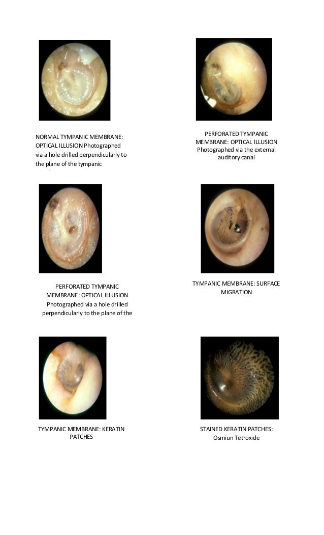 Abnormal Tympanic Membrane Findings abnormal-tympanic-membrane-findings