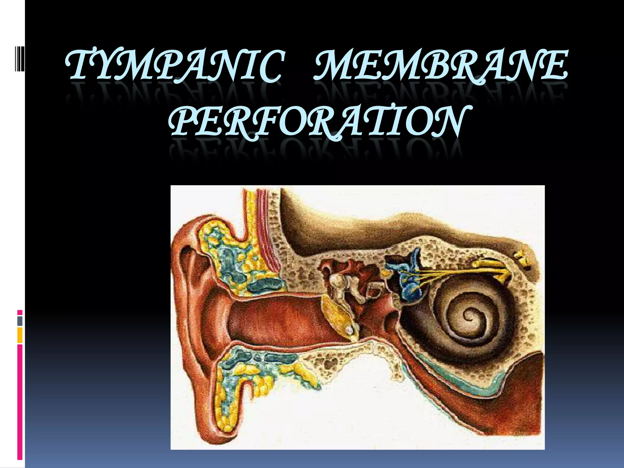 Tympanic membrane perforation | PPTX
