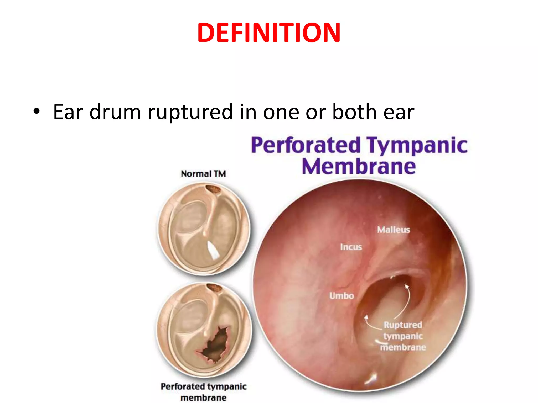 Tympanic membrane perforation | PPTX