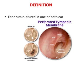 Tympanic membrane perforation