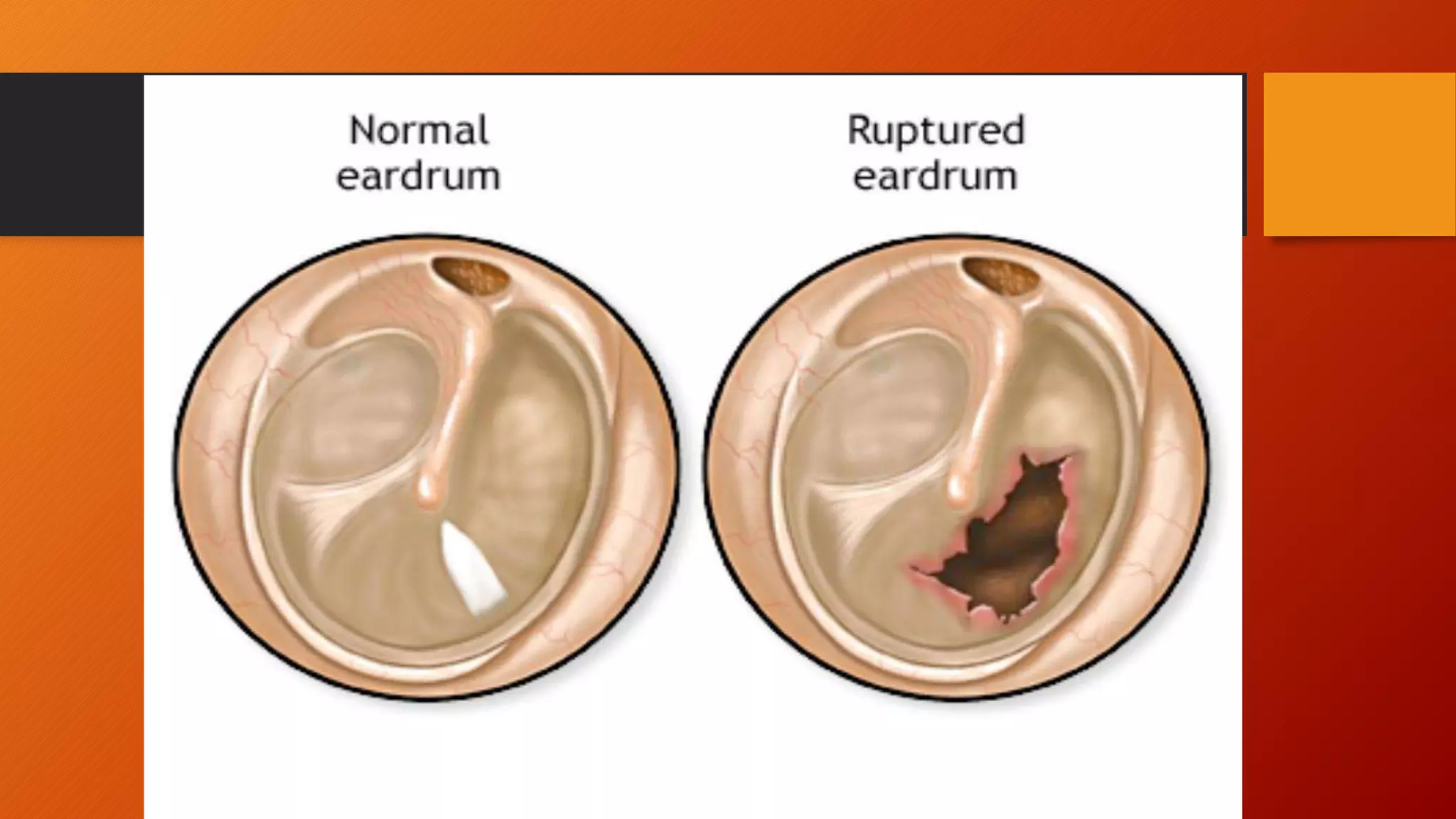 Tympanic membrane perforation | PPTX