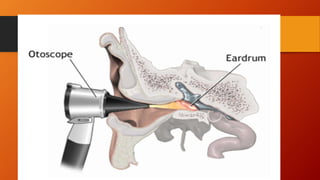 Tympanic membrane perforation | PPTX