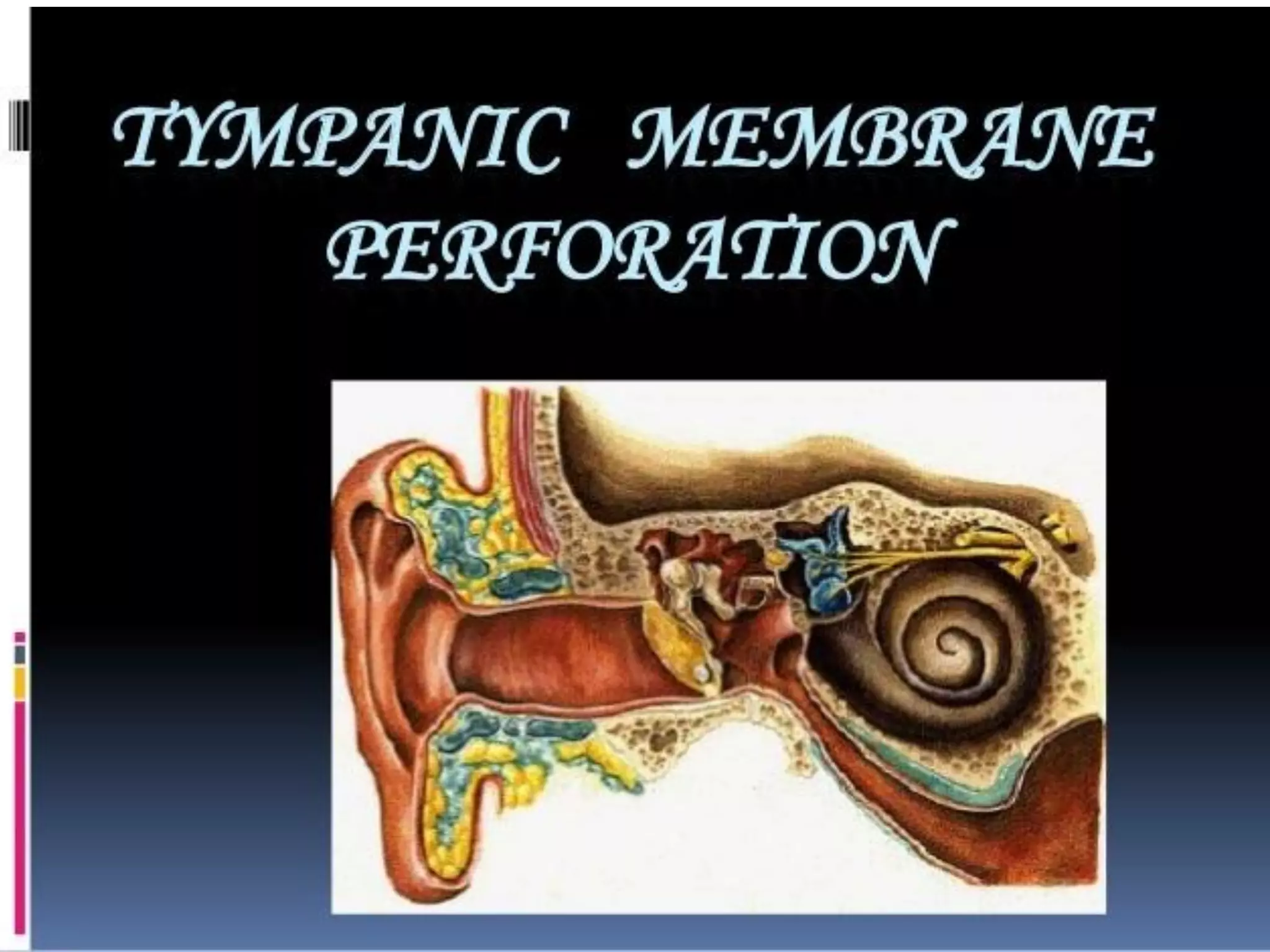 tympanic membrane perforation.pdf
