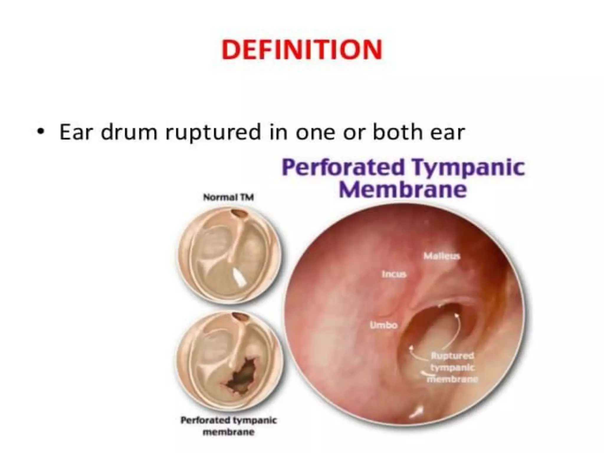 tympanic membrane perforation.pdf