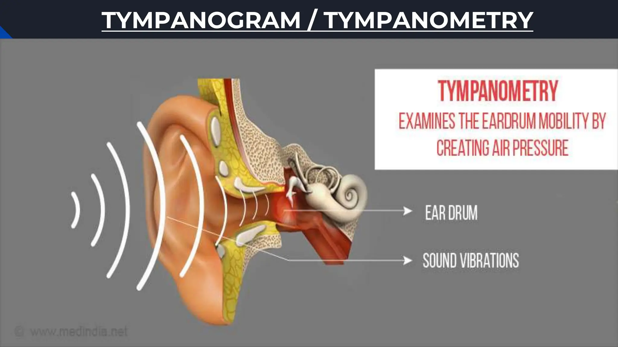 Tympanic membrane perforation.pptx