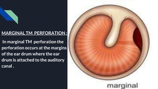 Tympanic membrane perforation.pptx | Ear, Nose and Throat Conditions ...