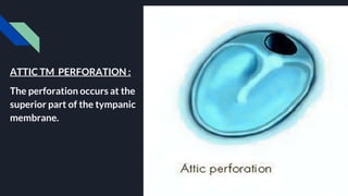 Tympanic membrane perforation.pptx | Ear, Nose and Throat Conditions ...
