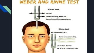 Tympanic membrane perforation.pptx