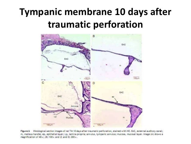 Tympanic perforation sponaneuos healing