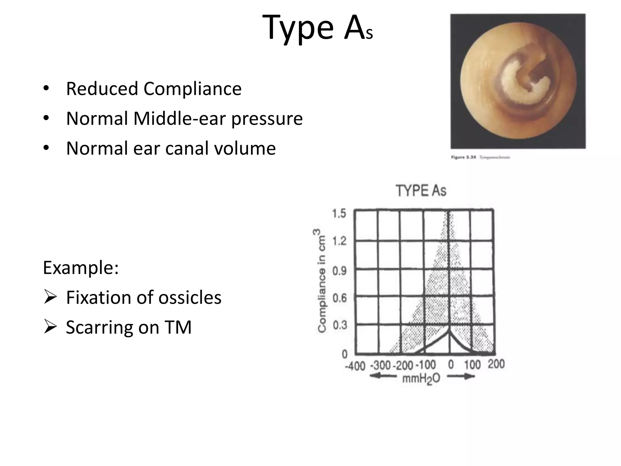 Tympanometry | PPTX