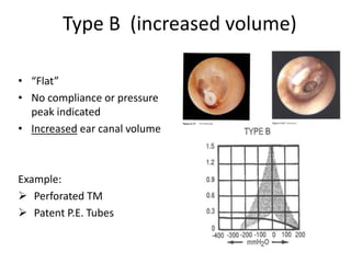 Tympanometry | PPTX