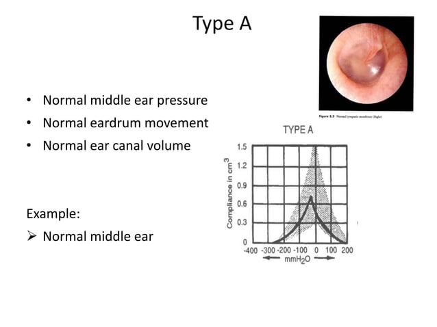 Tympanometry | PPTX | Ear, Nose and Throat Conditions | Diseases and ...