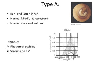 Tympanometry | PPTX