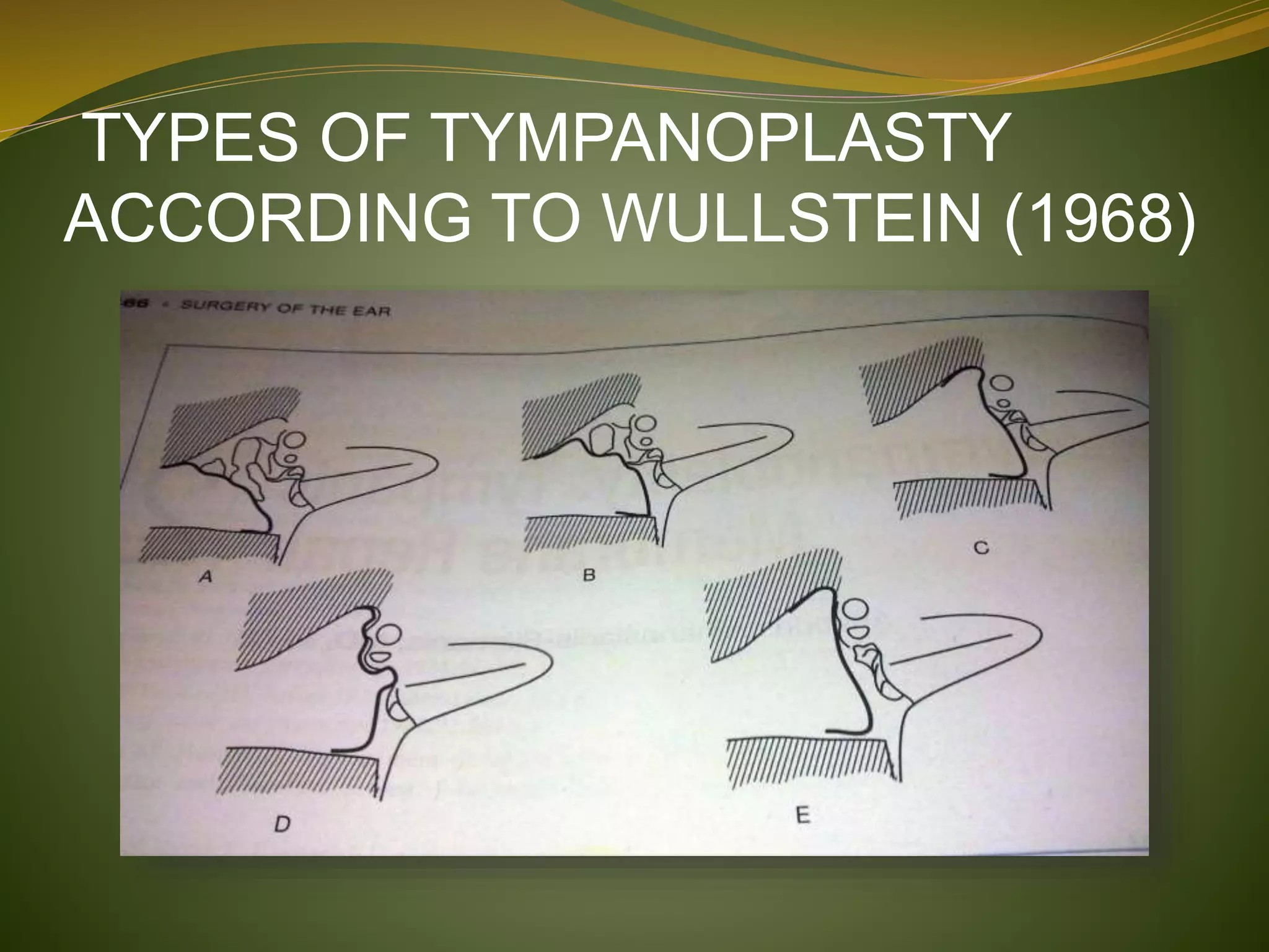 Tympanoplasty; Indications, types, anesthesia, surgical procedure. | PPT