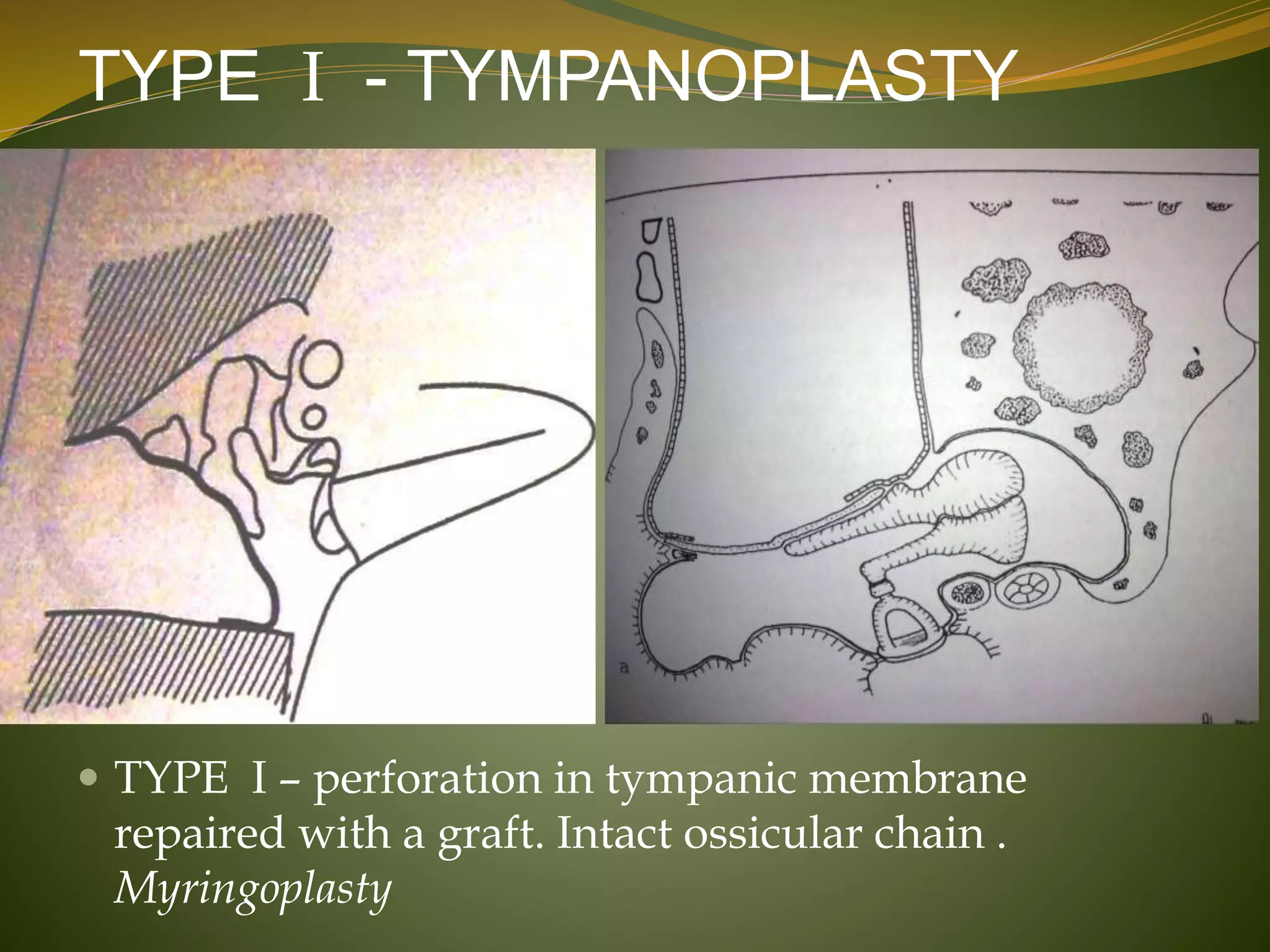 Tympanoplasty; Indications, types, anesthesia, surgical procedure. | PPT
