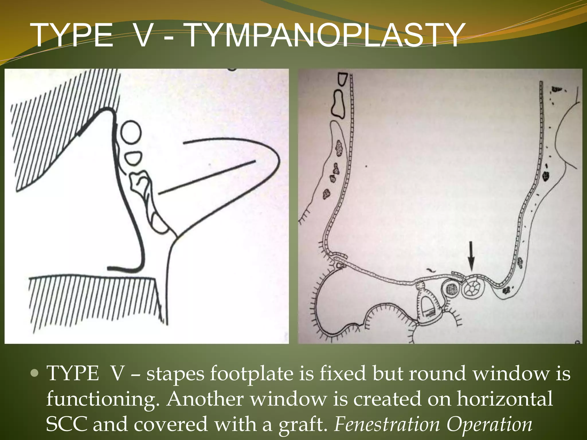 Tympanoplasty; Indications, types, anesthesia, surgical procedure. | PPT