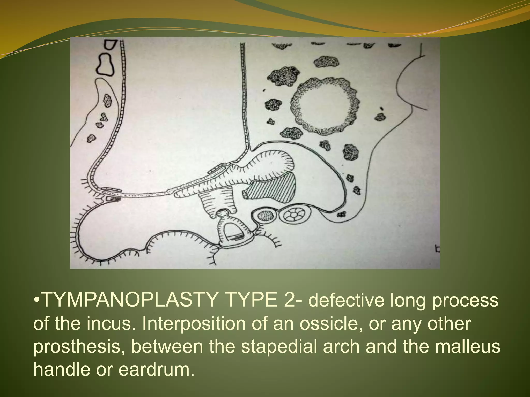 Tympanoplasty; Indications, types, anesthesia, surgical procedure. | PPT